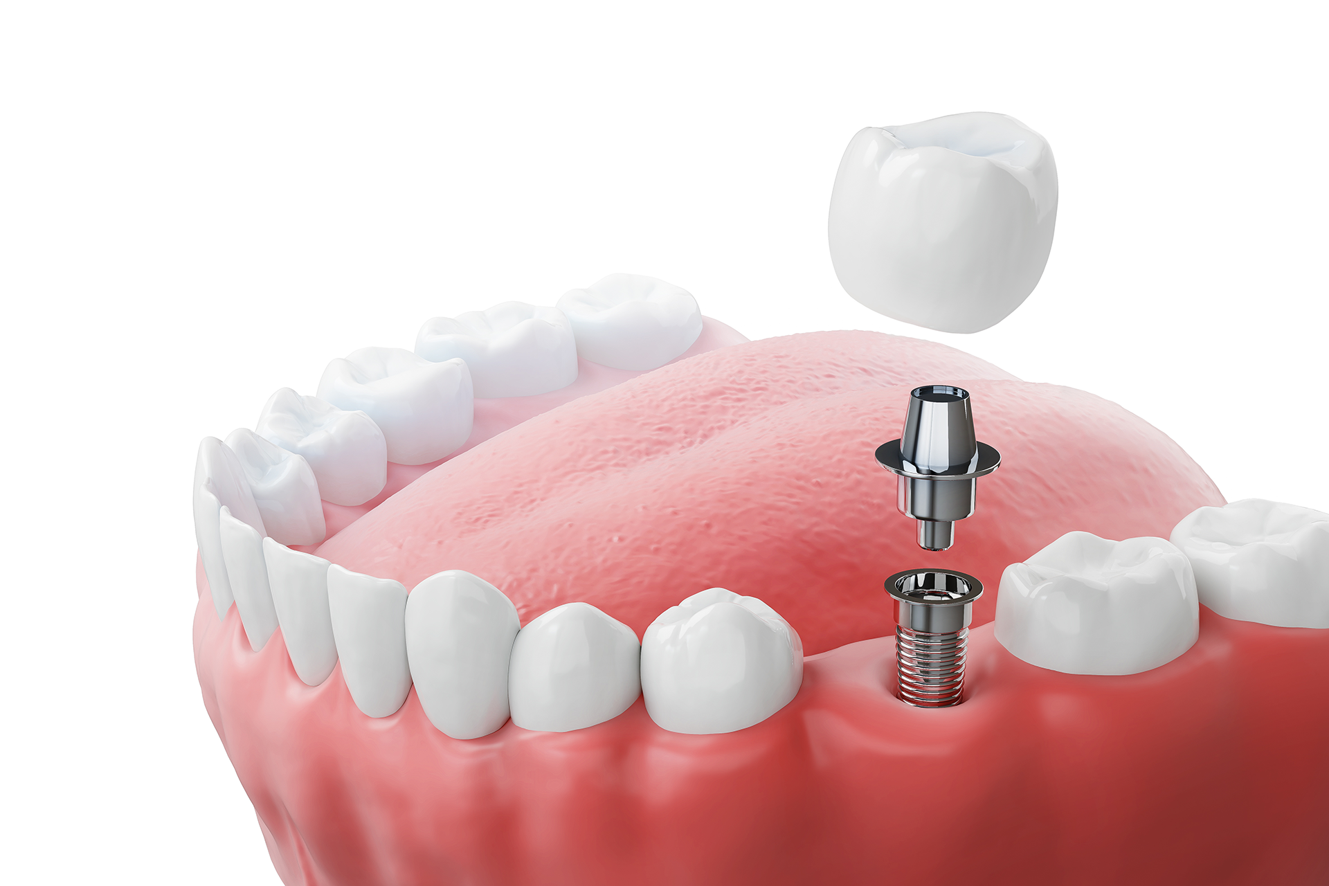 What Are Dental Implants Made Of? | Coastal Dental Group